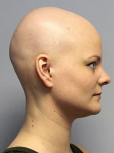 Alopecia - Hair Conditions - UK Hair Consultants